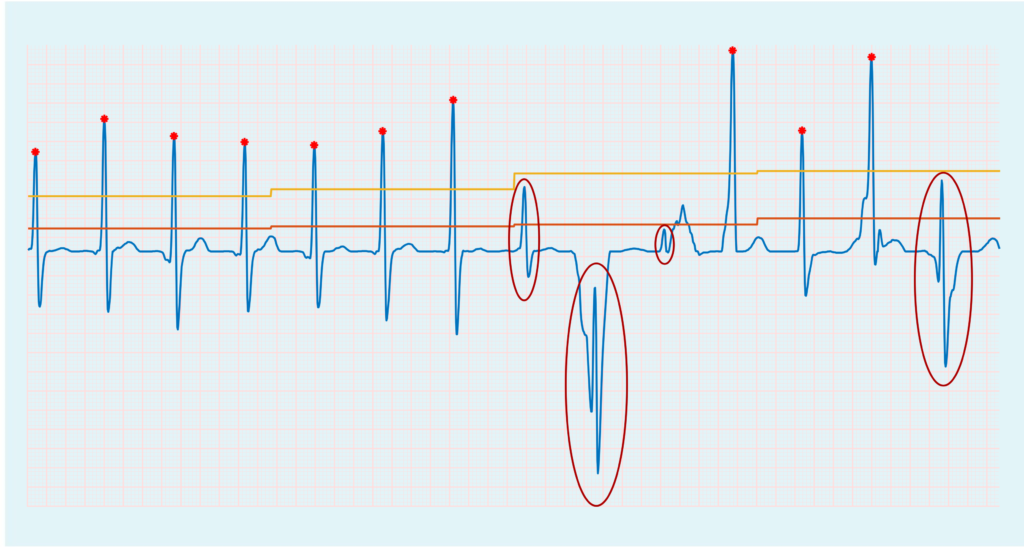 ECG in High Intensity Exercise Dataset – Deep Health